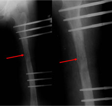 Rotational Deformity & Shortening